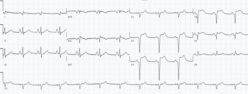 ECG Cases 41 - STEMI, Occlusion MI Complications