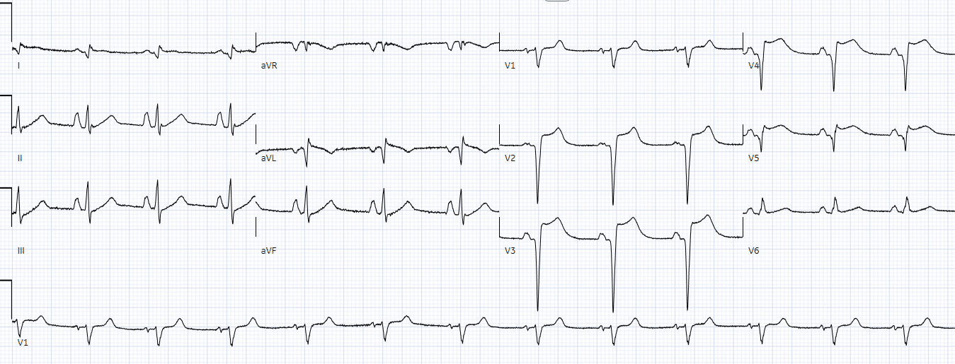 ECG Cases 41 - STEMI, Occlusion MI Complications