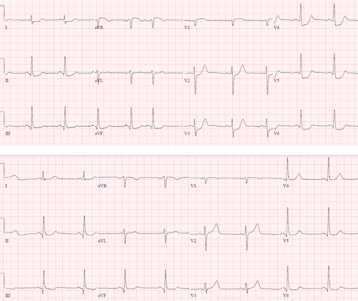 ECG Cases 41 - STEMI, Occlusion MI Complications