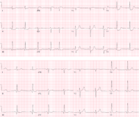ECG Cases 41 - STEMI, Occlusion MI Complications