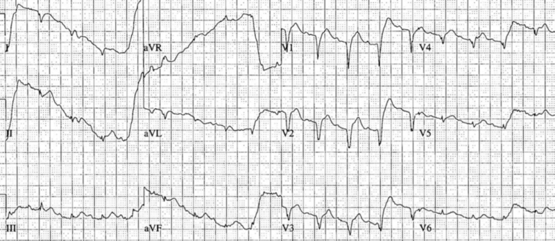 ECG Cases 41 – STEMI, Occlusion MI Complications - האיגוד הישראלי ...
