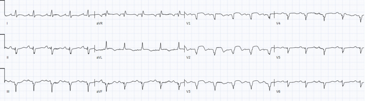 ECG Cases 41 - STEMI, Occlusion MI Complications