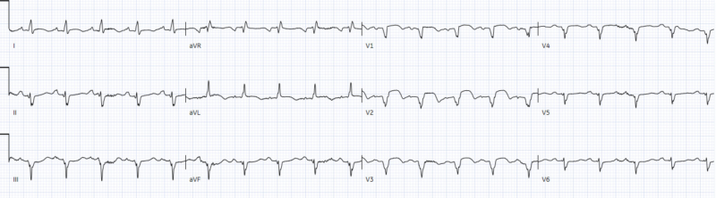 ECG Cases 41 - STEMI, Occlusion MI Complications