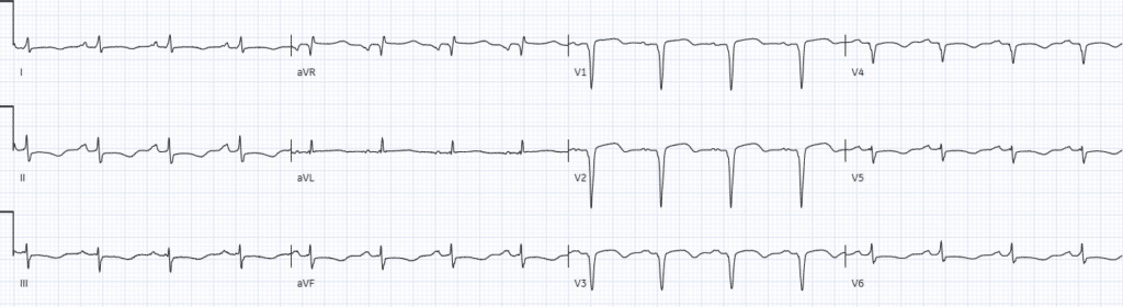 ECG Cases 41 - STEMI, Occlusion MI Complications