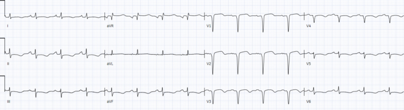 ECG Cases 41 - STEMI, Occlusion MI Complications