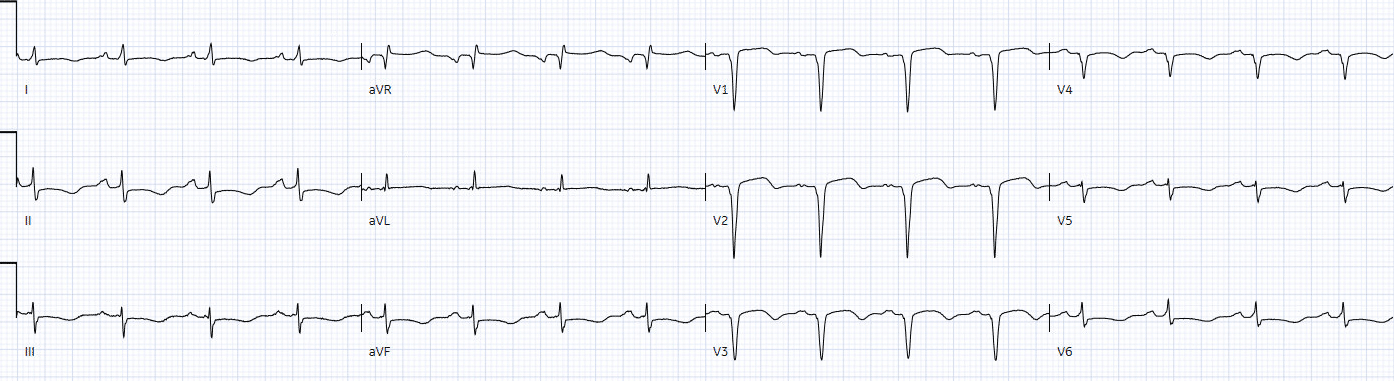 ECG Cases 41 - STEMI, Occlusion MI Complications