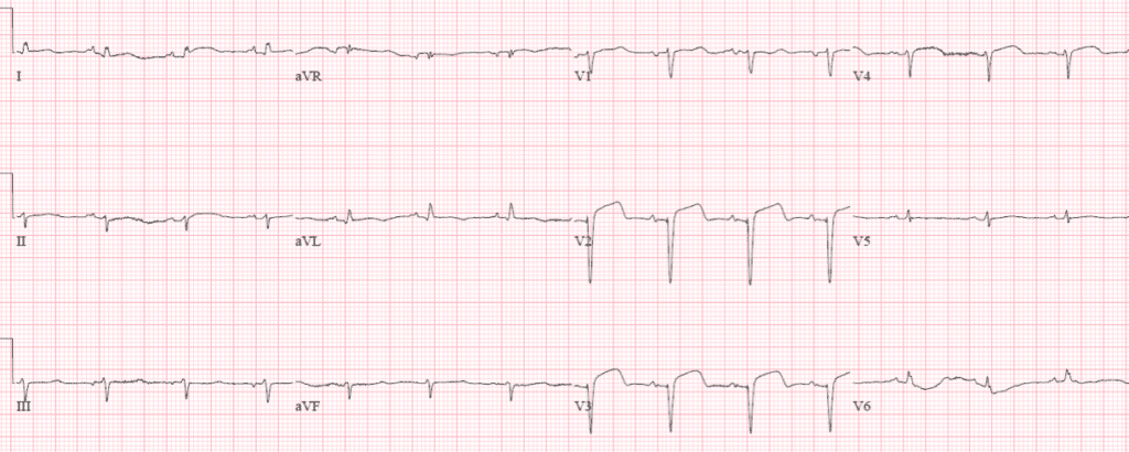 ECG Cases 41 – STEMI, Occlusion MI Complications - האיגוד הישראלי ...