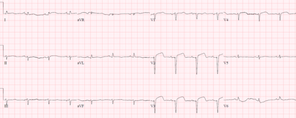 ECG Cases 41 - STEMI, Occlusion MI Complications
