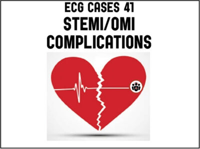 ECG Cases 41 – STEMI, Occlusion MI Complications - האיגוד הישראלי ...