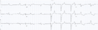 ECG interpretation in chest pain | ECG Cases | EM Cases