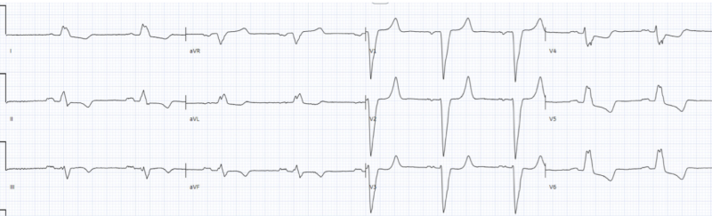 ECG interpretation in chest pain | ECG Cases | EM Cases