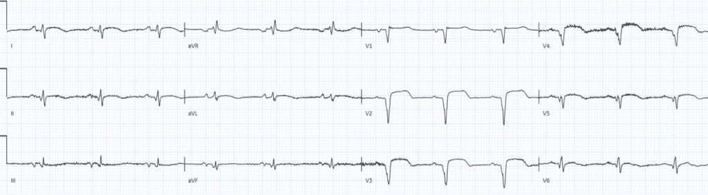 ECG interpretation in chest pain | ECG Cases | EM Cases