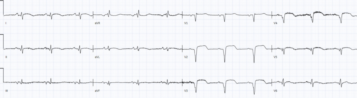 ECG interpretation in chest pain | ECG Cases | EM Cases