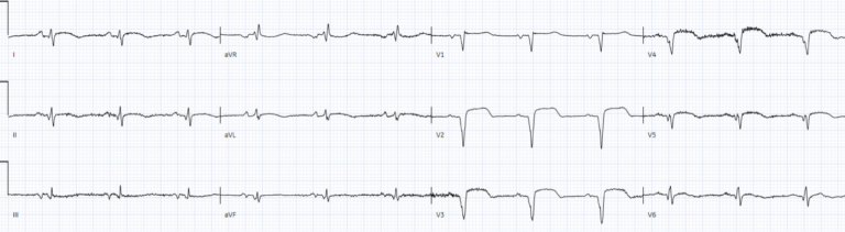 ECG interpretation in chest pain | ECG Cases | EM Cases