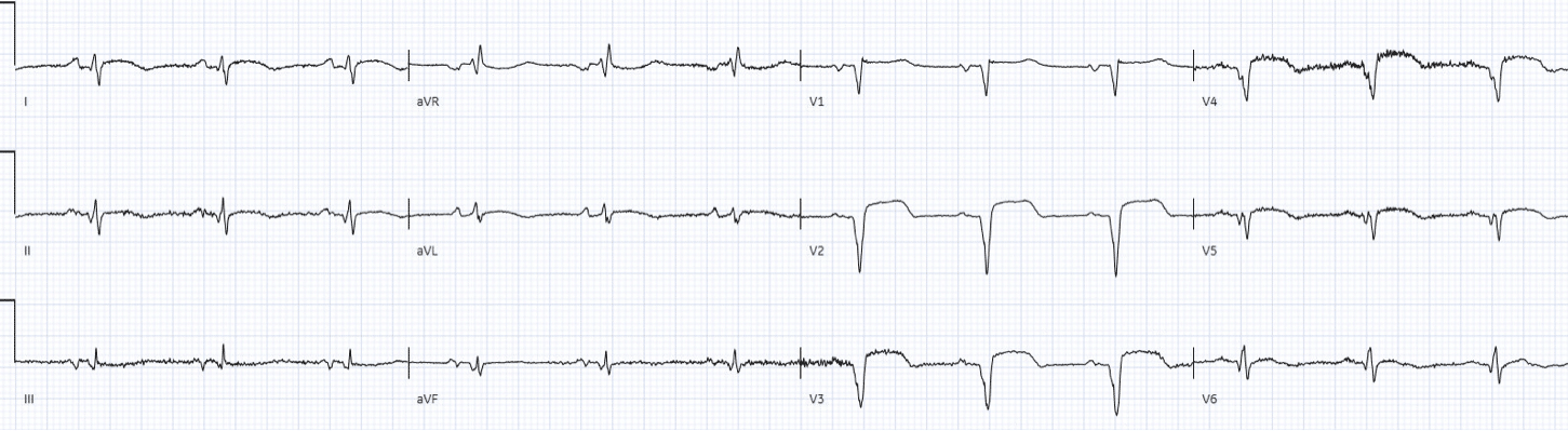 ECG interpretation in chest pain | ECG Cases | EM Cases
