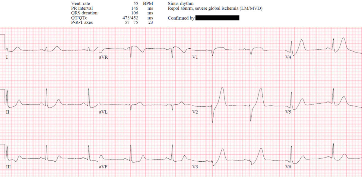 ECG interpretation in chest pain | ECG Cases | EM Cases