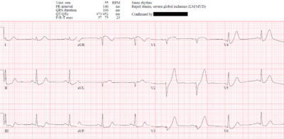 ECG interpretation in chest pain | ECG Cases | EM Cases
