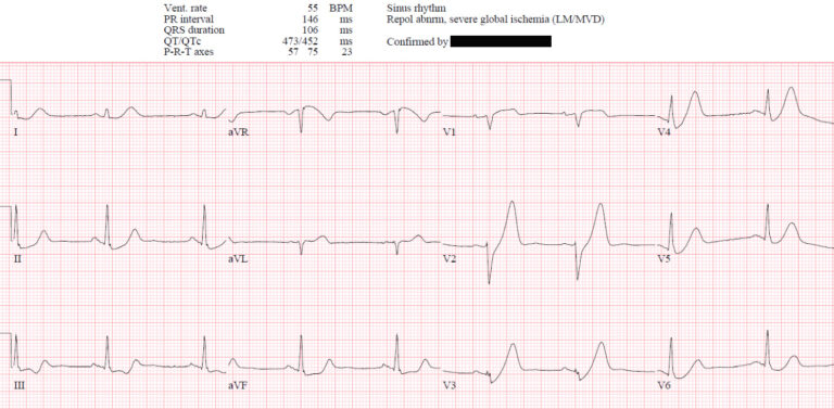 ECG interpretation in chest pain | ECG Cases | EM Cases
