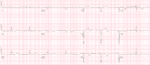 ECG interpretation in chest pain | ECG Cases | EM Cases