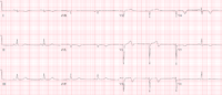 ECG interpretation in chest pain | ECG Cases | EM Cases