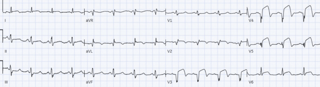 ECG interpretation in chest pain | ECG Cases | EM Cases