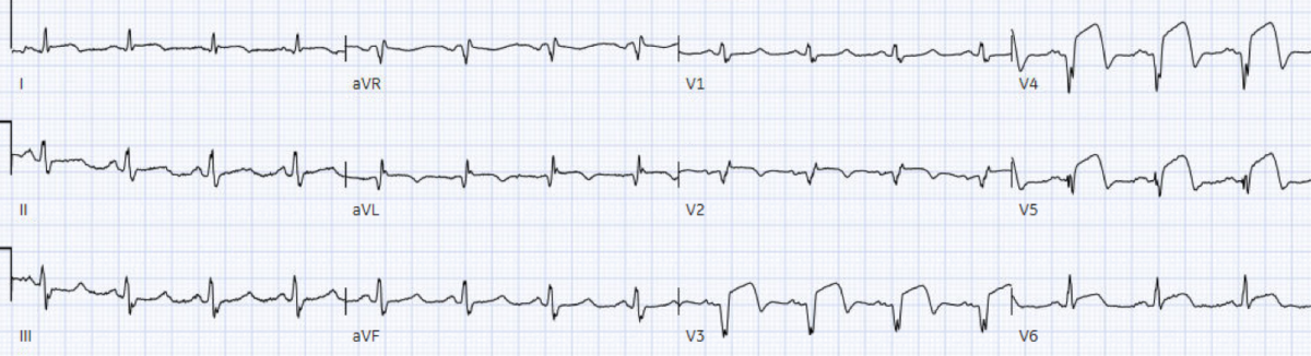 ECG interpretation in chest pain | ECG Cases | EM Cases