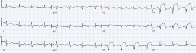 ECG interpretation in chest pain | ECG Cases | EM Cases