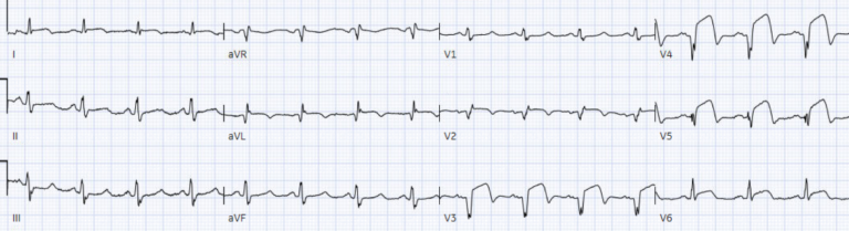 ECG interpretation in chest pain | ECG Cases | EM Cases