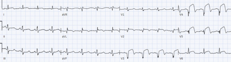ECG interpretation in chest pain | ECG Cases | EM Cases