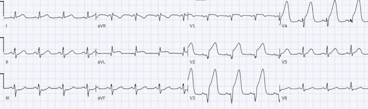 ECG interpretation in chest pain | ECG Cases | EM Cases