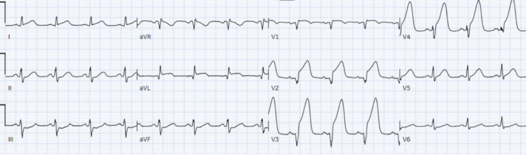 ECG interpretation in chest pain | ECG Cases | EM Cases