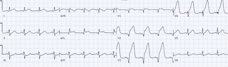 ECG interpretation in chest pain | ECG Cases | EM Cases