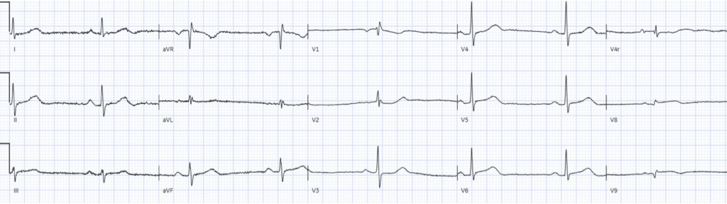 ECG interpretation in chest pain | ECG Cases | EM Cases
