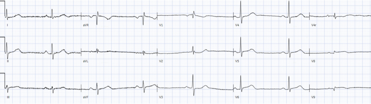 ECG interpretation in chest pain | ECG Cases | EM Cases
