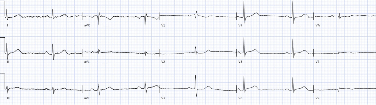 ECG interpretation in chest pain | ECG Cases | EM Cases