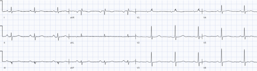 ECG interpretation in chest pain | ECG Cases | EM Cases