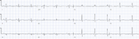 ECG interpretation in chest pain | ECG Cases | EM Cases