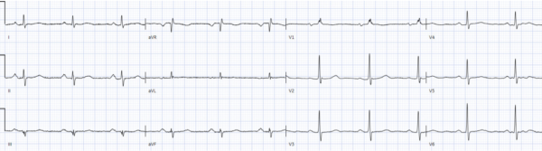 ECG interpretation in chest pain | ECG Cases | EM Cases