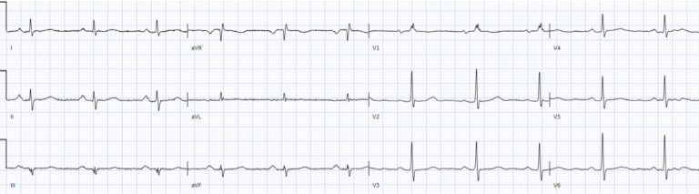 ECG interpretation in chest pain | ECG Cases | EM Cases