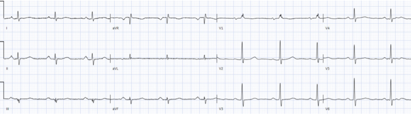 ECG interpretation in chest pain | ECG Cases | EM Cases