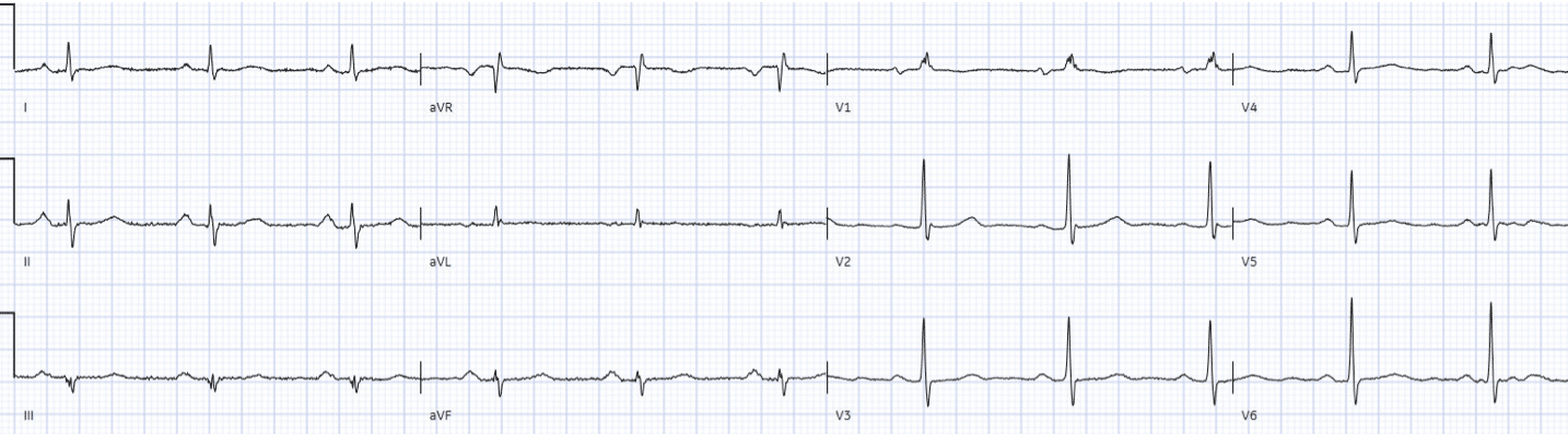 ECG interpretation in chest pain | ECG Cases | EM Cases