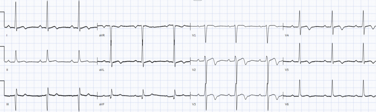ECG interpretation in chest pain | ECG Cases | EM Cases