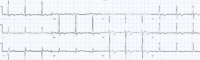 ECG interpretation in chest pain | ECG Cases | EM Cases