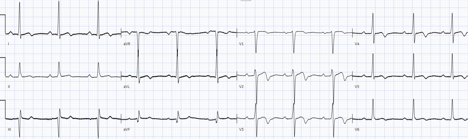 ECG interpretation in chest pain | ECG Cases | EM Cases