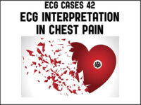 ECG interpretation in chest pain | ECG Cases | EM Cases