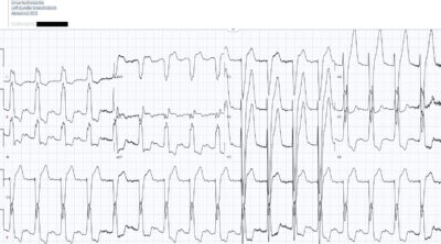 ECG Interpretation in Shortness of Breath | ECG Cases | EM Cases