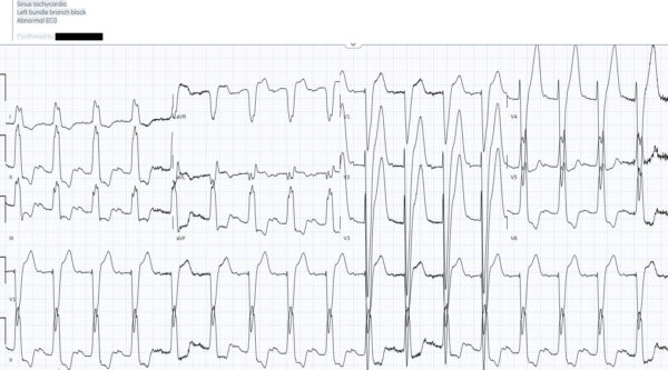 ECG Interpretation in Shortness of Breath | ECG Cases | EM Cases