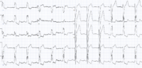 ECG Interpretation in Shortness of Breath | ECG Cases | EM Cases