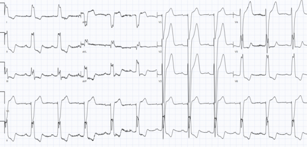 ECG Interpretation in Shortness of Breath | ECG Cases | EM Cases