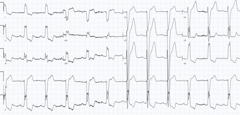 ECG Interpretation in Shortness of Breath | ECG Cases | EM Cases